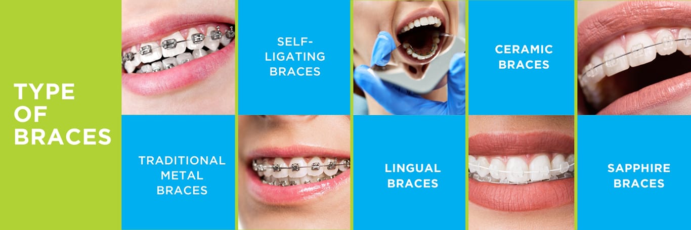 Metal Braces vs Clear Braces: Pros & Cons - Image Orthodontics