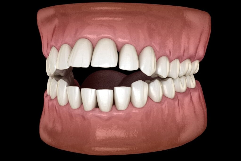 Can Invisalign Fix Open Bite? - Image Orthodontics